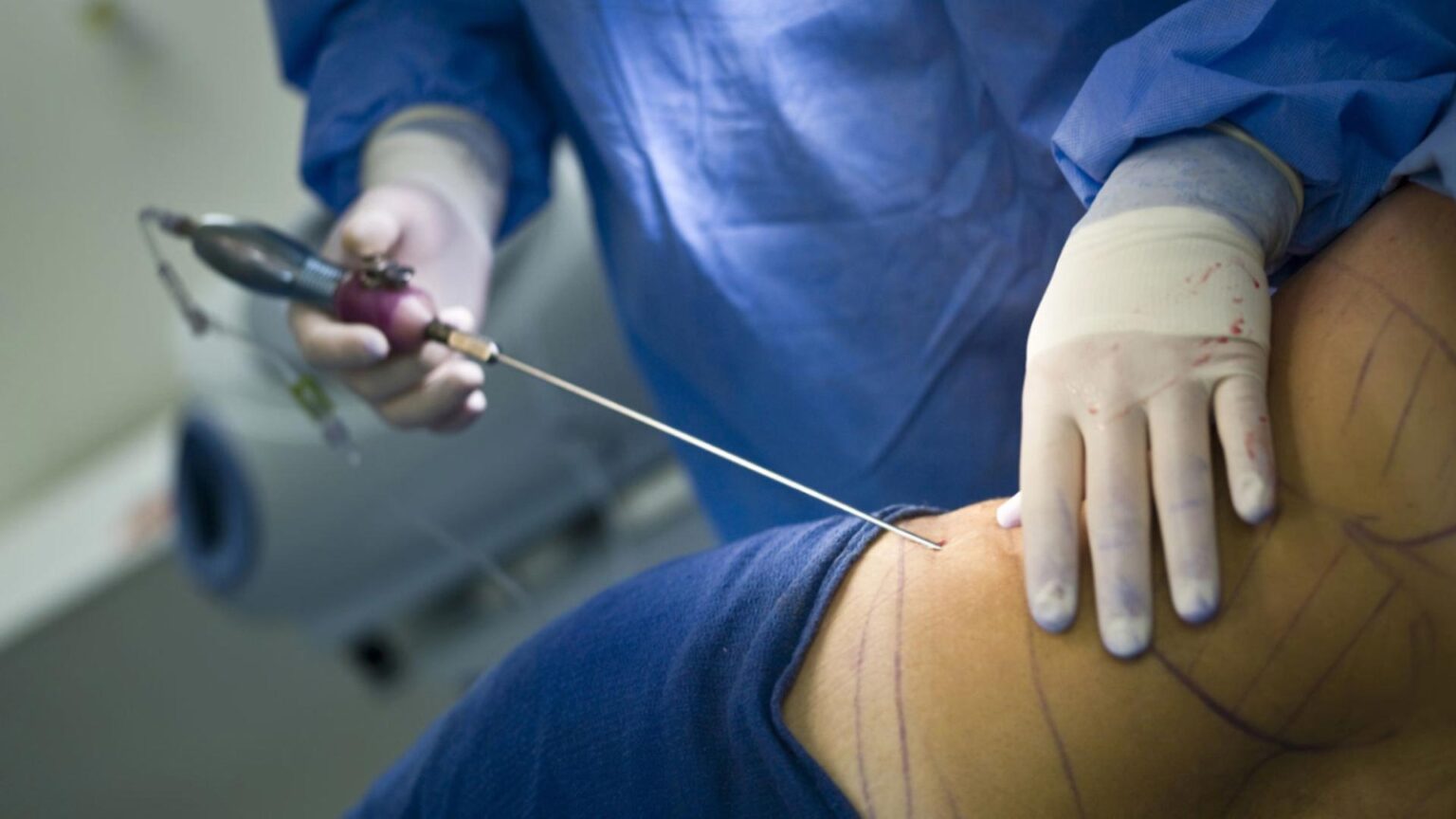 BBL Surgery in Turkey: A Complete Guide to Enhance Your Buttocks and ...